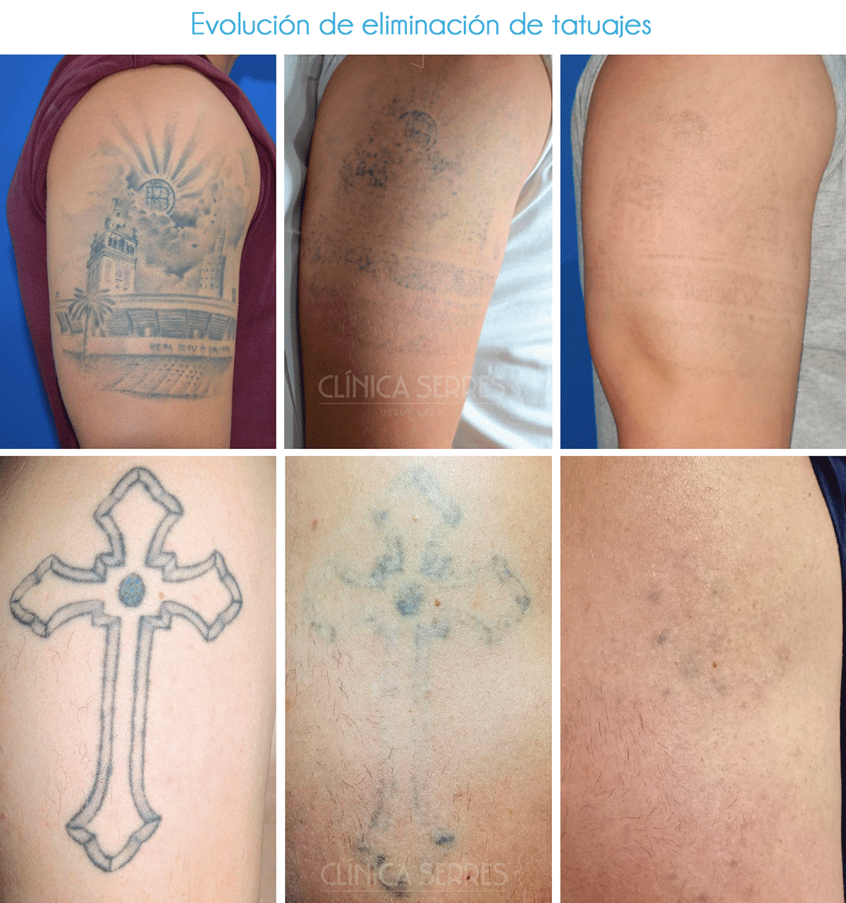 Eliminación De Tatuajes Antes Y Después